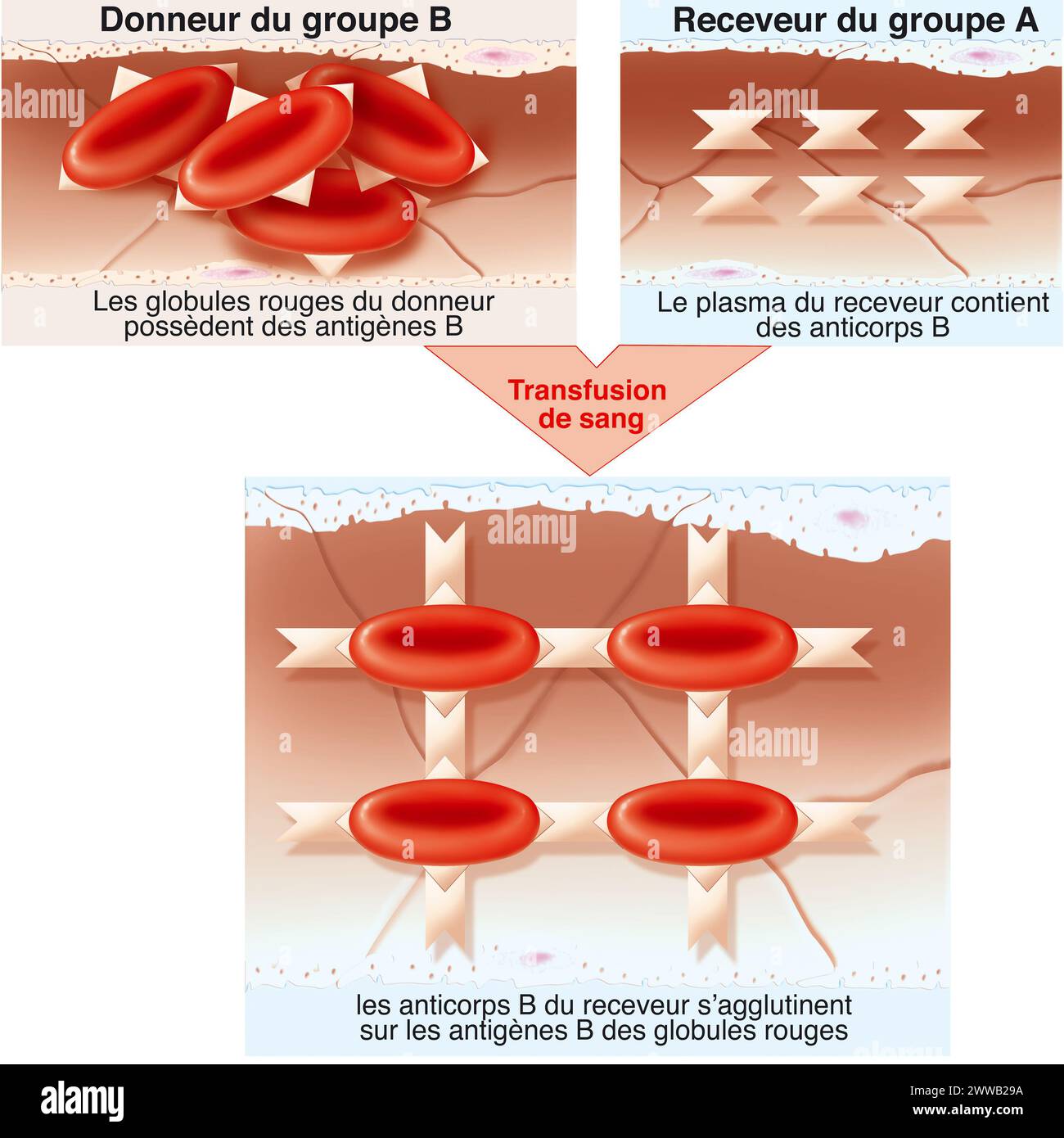 Transfusion incompatible. Representation of the incompatibility between ...
