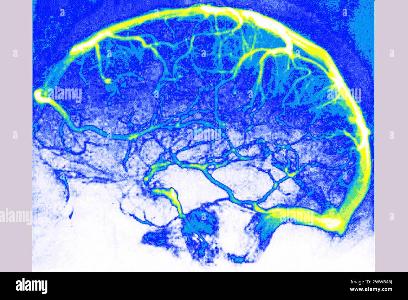 Cerebral angiography (x-ray examination visualizing the arteries and ...