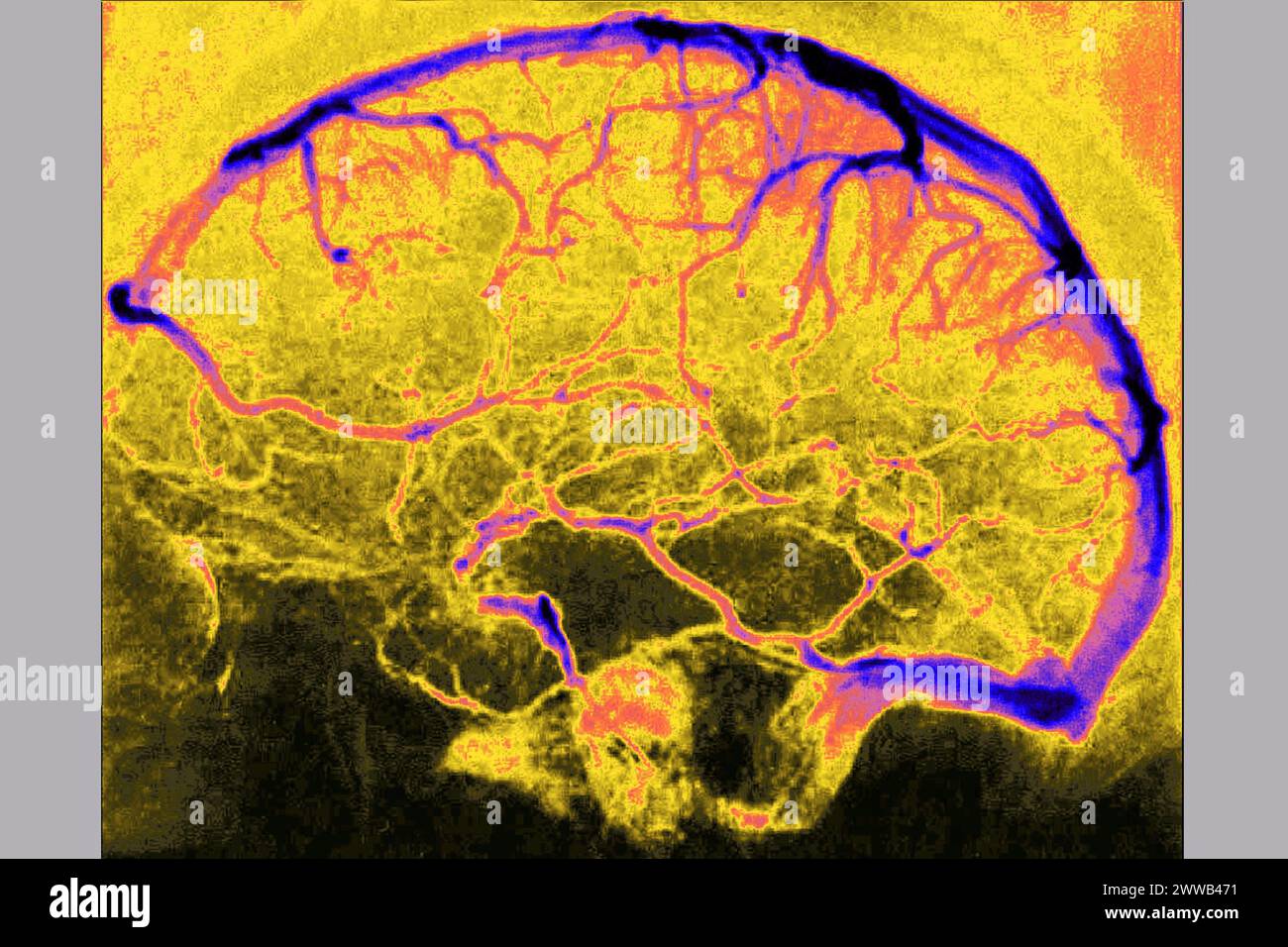 Cerebral angiography (x-ray examination visualizing the arteries and ...