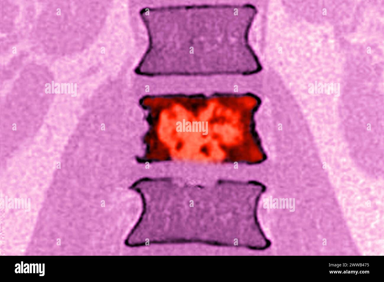Vertebral osteitis (inflammation of the bone tissue of a lumbar ...