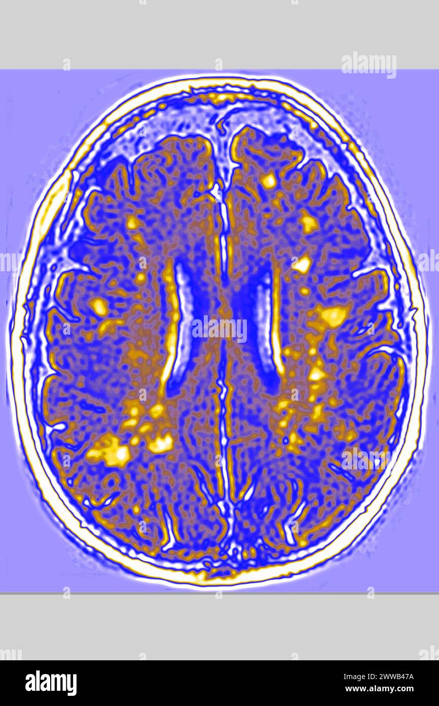 Leukoaraiosis (damage to the small vessels of the cerebral white matter ...