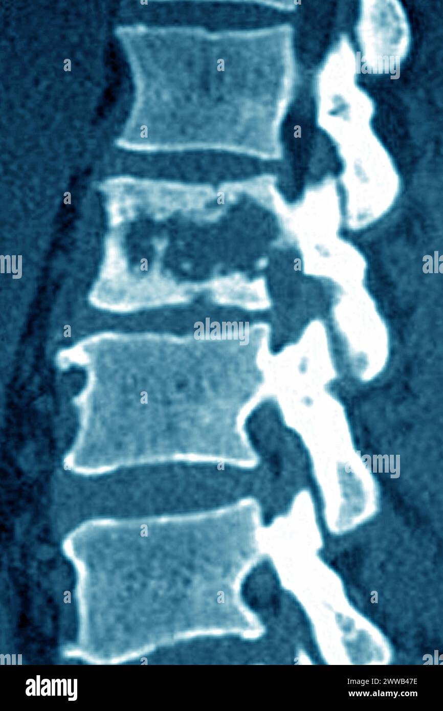 Vertebral osteitis (inflammation of the bone tissue of a lumbar ...