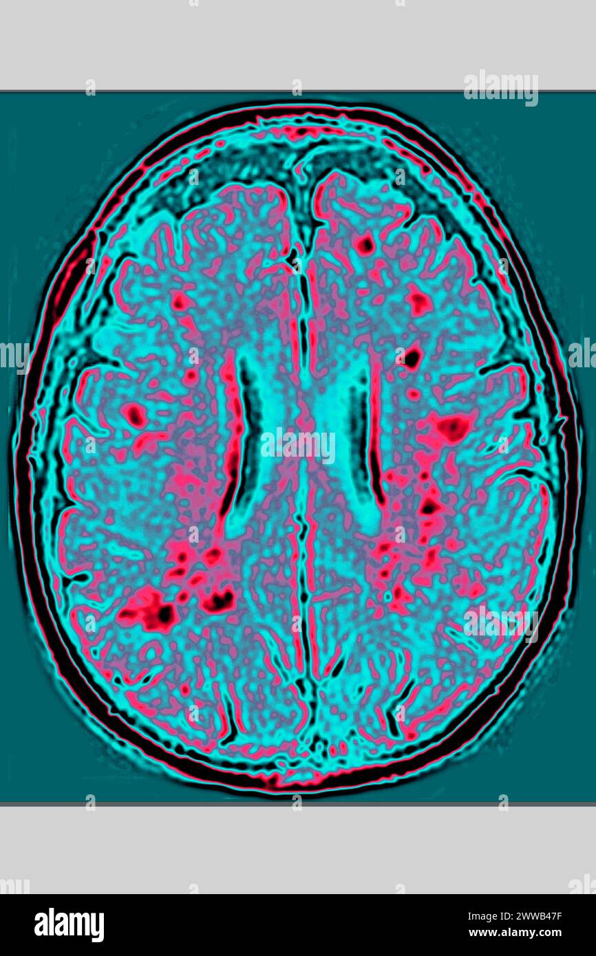 Leukoaraiosis (damage to the small vessels of the cerebral white matter ...
