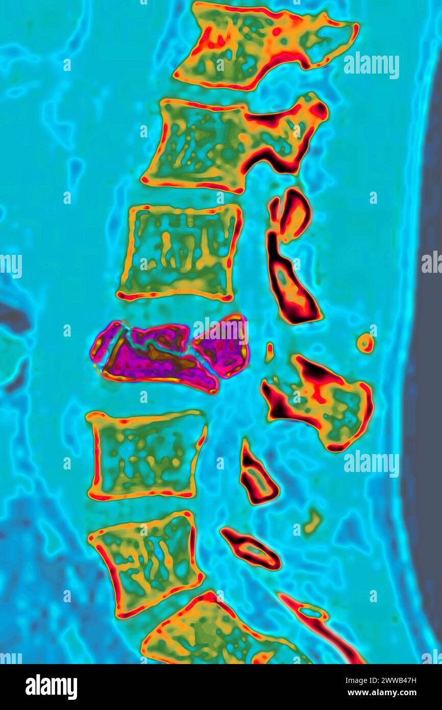 Spontaneous vertebral fracture due to oteoporosis (bone disease ...