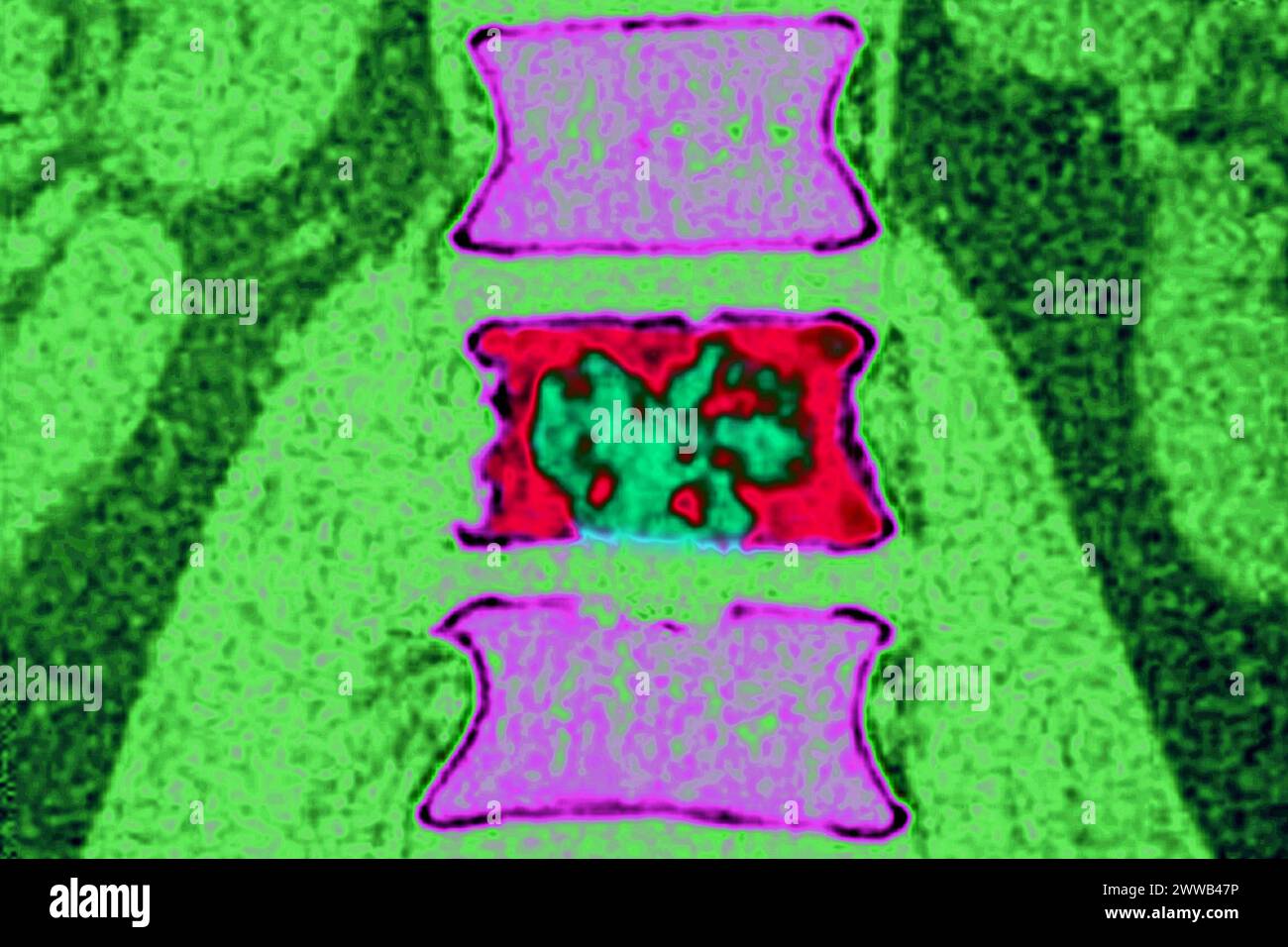 Vertebral osteitis (inflammation of the bone tissue of a lumbar ...