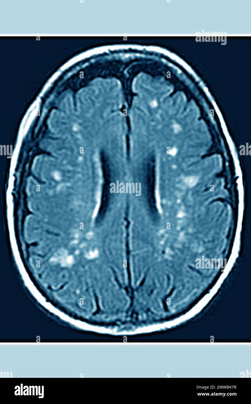 Leukoaraiosis (damage to the small vessels of the cerebral white matter ...