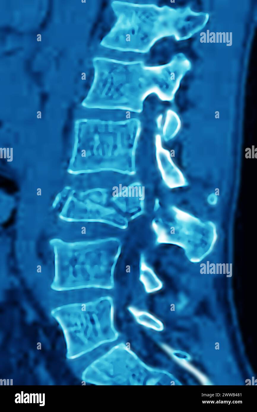 Spontaneous vertebral fracture due to oteoporosis (bone disease ...