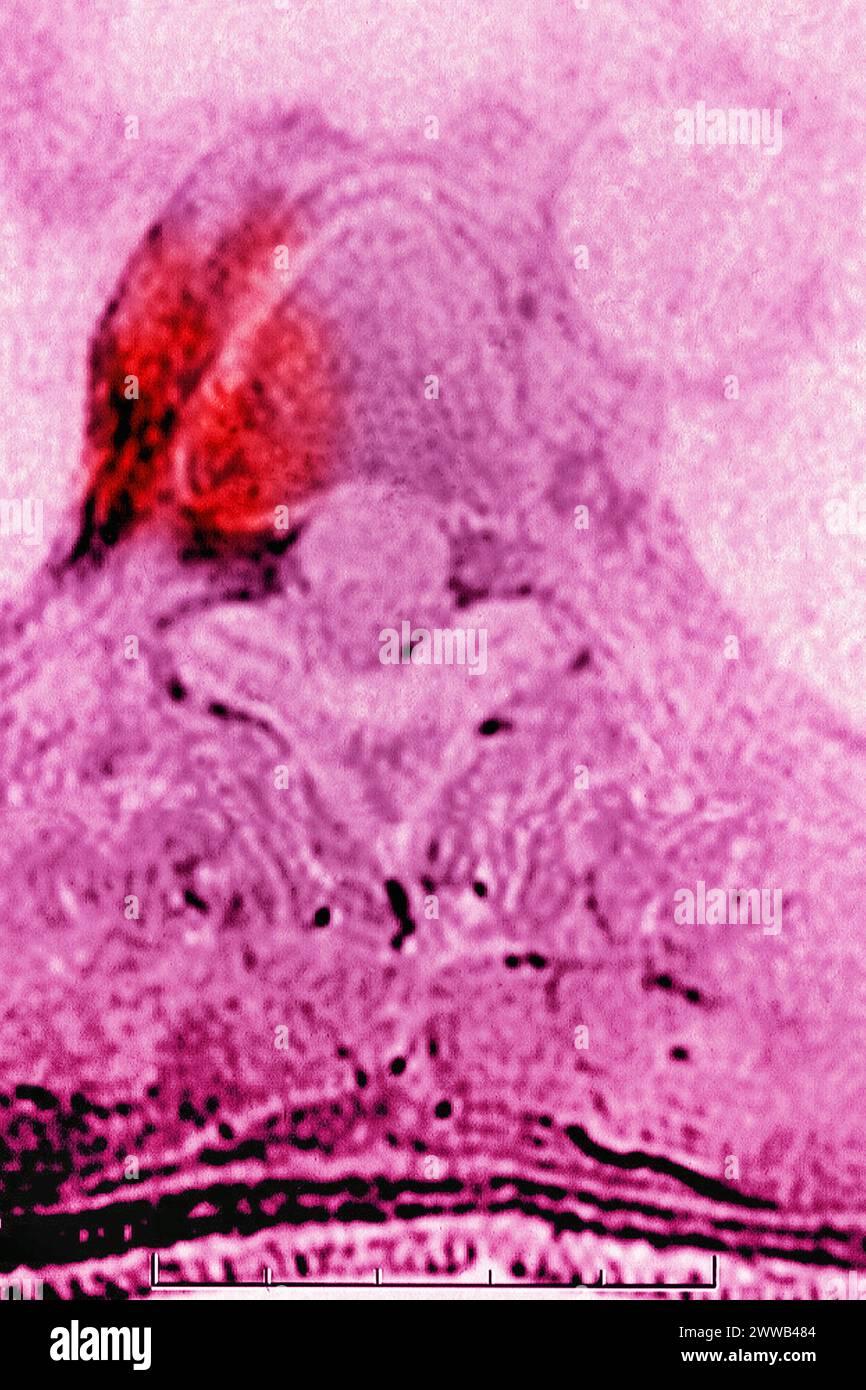 Vertebral osteitis (inflammation of bone tissue in a dorsal vertebra ...