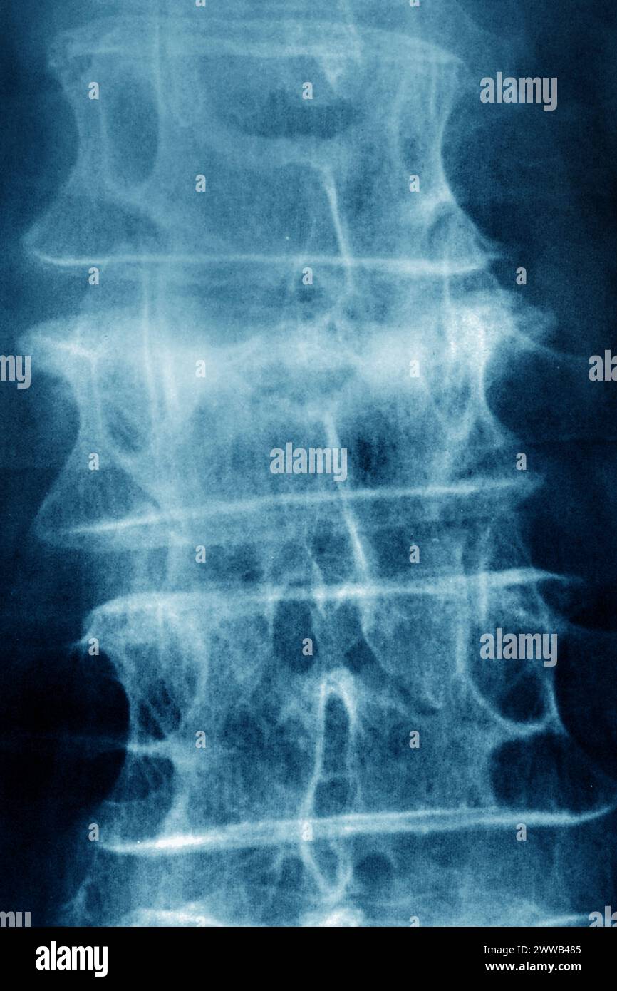 Bone disease hi-res stock photography and images - Alamy