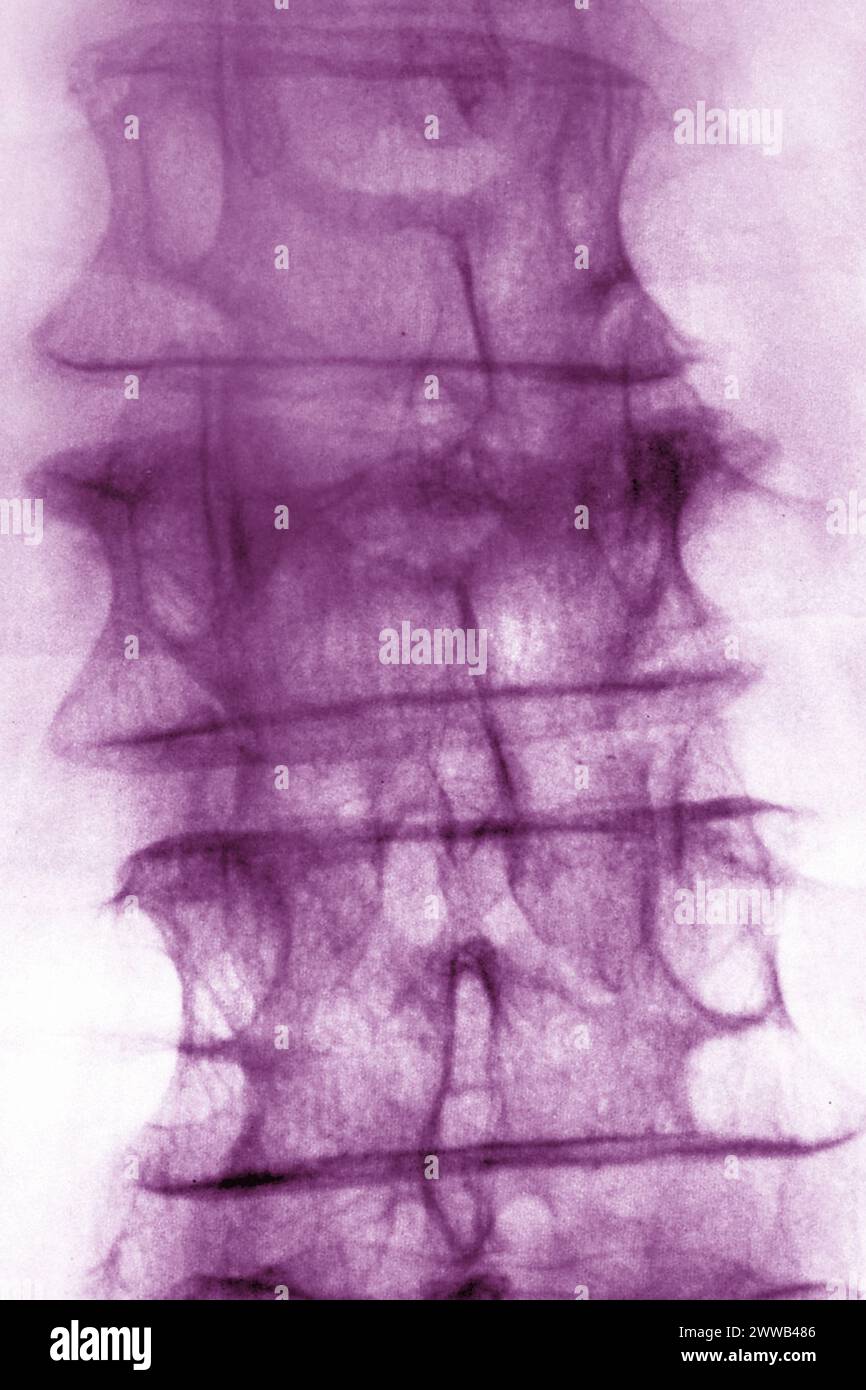 Vertebral osteoporosis (bone disease characterized by a decrease in ...