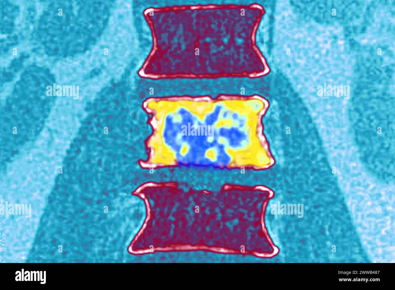 Vertebral osteitis (inflammation of the bone tissue of a lumbar ...