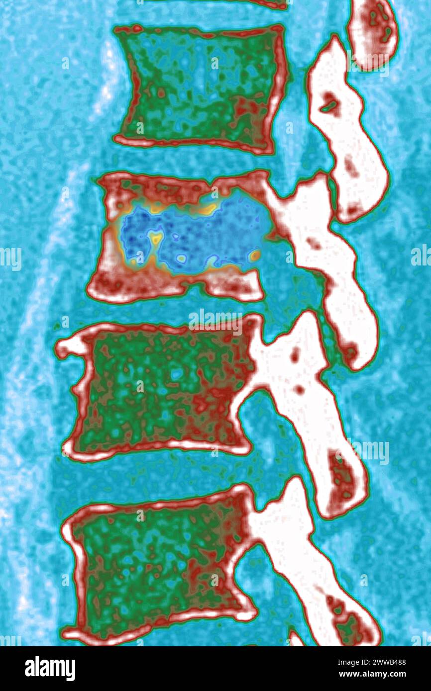 Vertebral osteitis (inflammation of the bone tissue of a lumbar ...