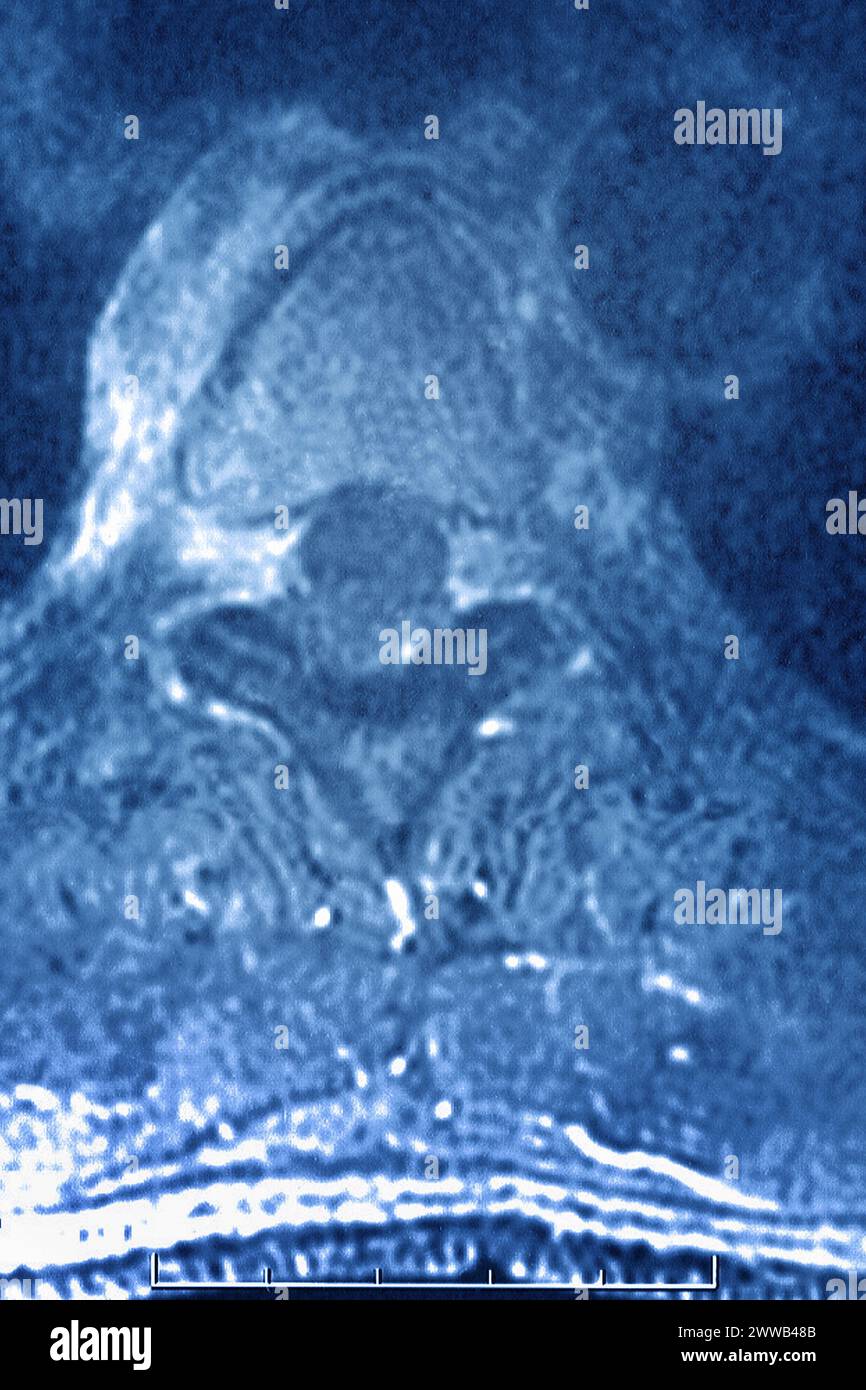 Vertebral osteitis (inflammation of bone tissue in a dorsal vertebra ...
