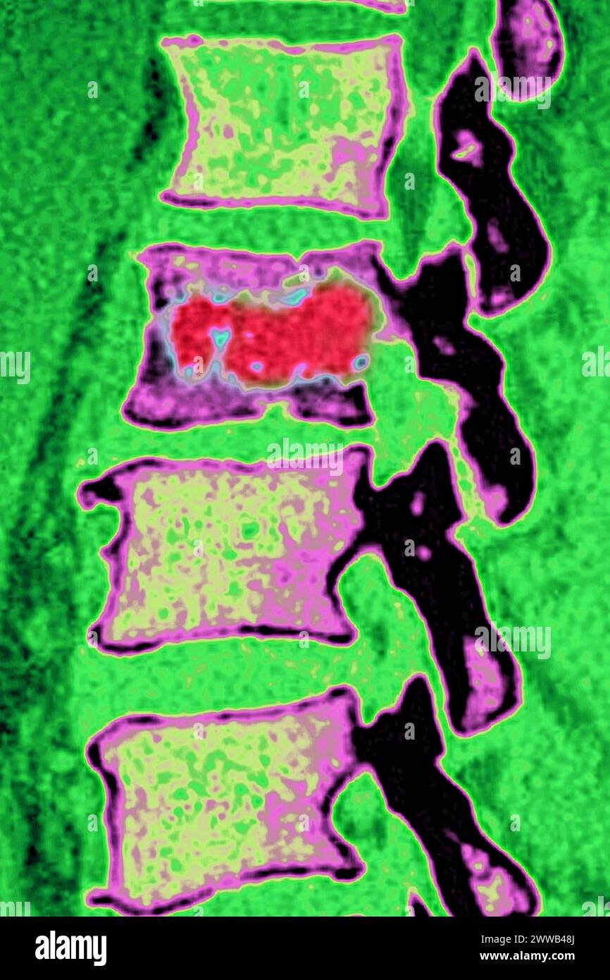 Vertebral osteitis (inflammation of the bone tissue of a lumbar ...