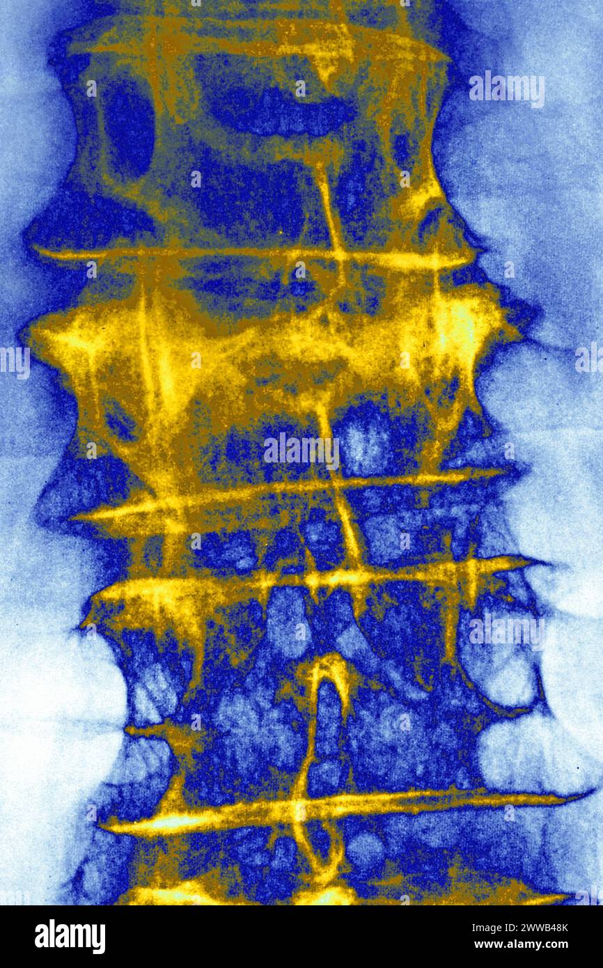 Bone disease hi-res stock photography and images - Alamy