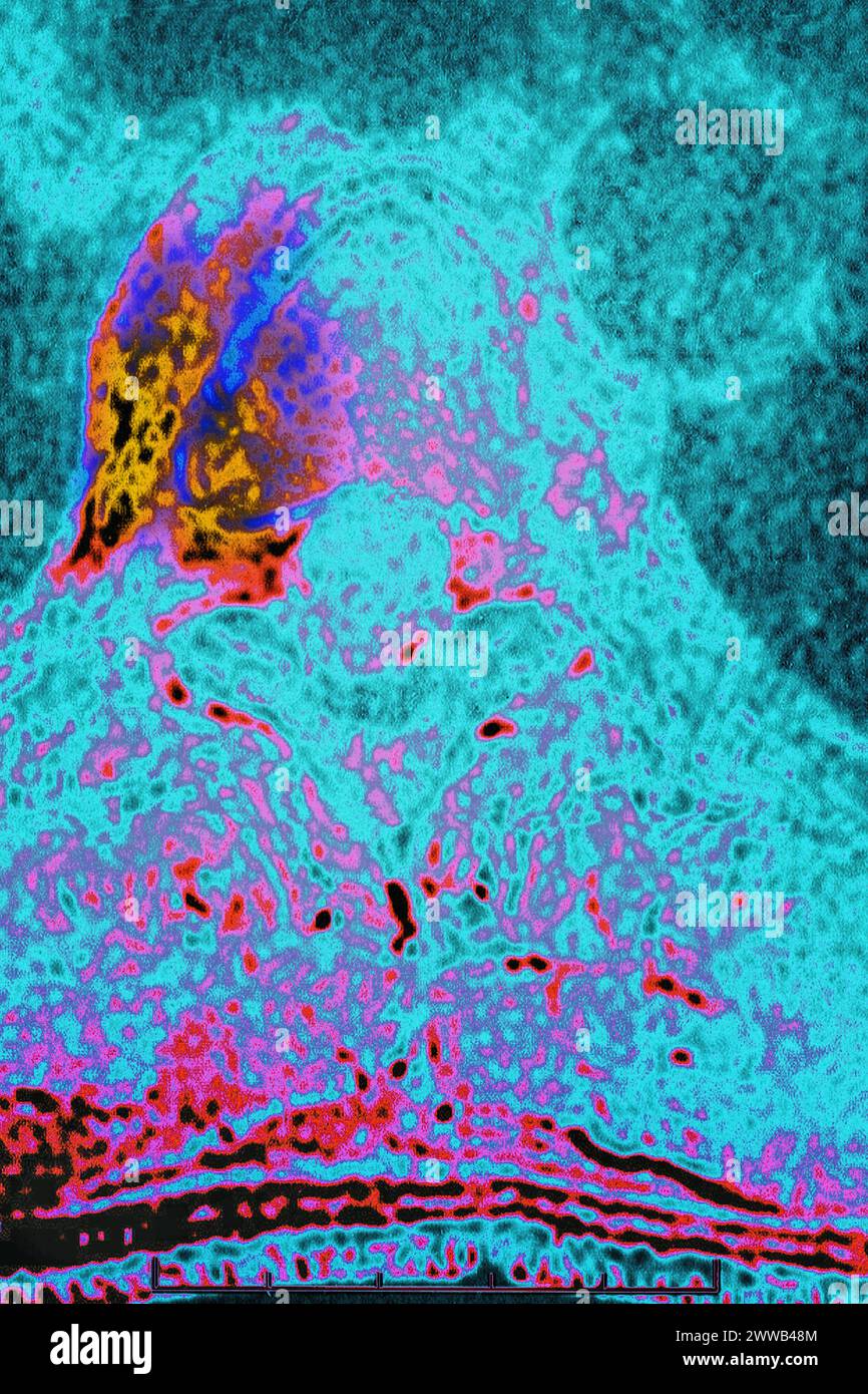 Vertebral osteitis (inflammation of bone tissue in a dorsal vertebra ...