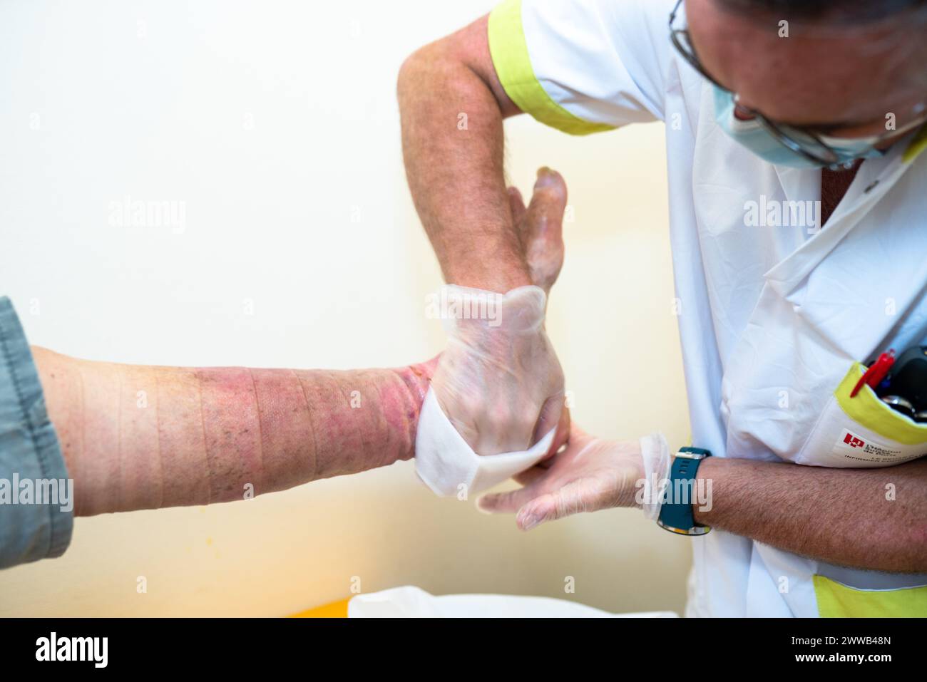 Care of a patient's foot ulcer. Wound cleaning and dressings Stock ...