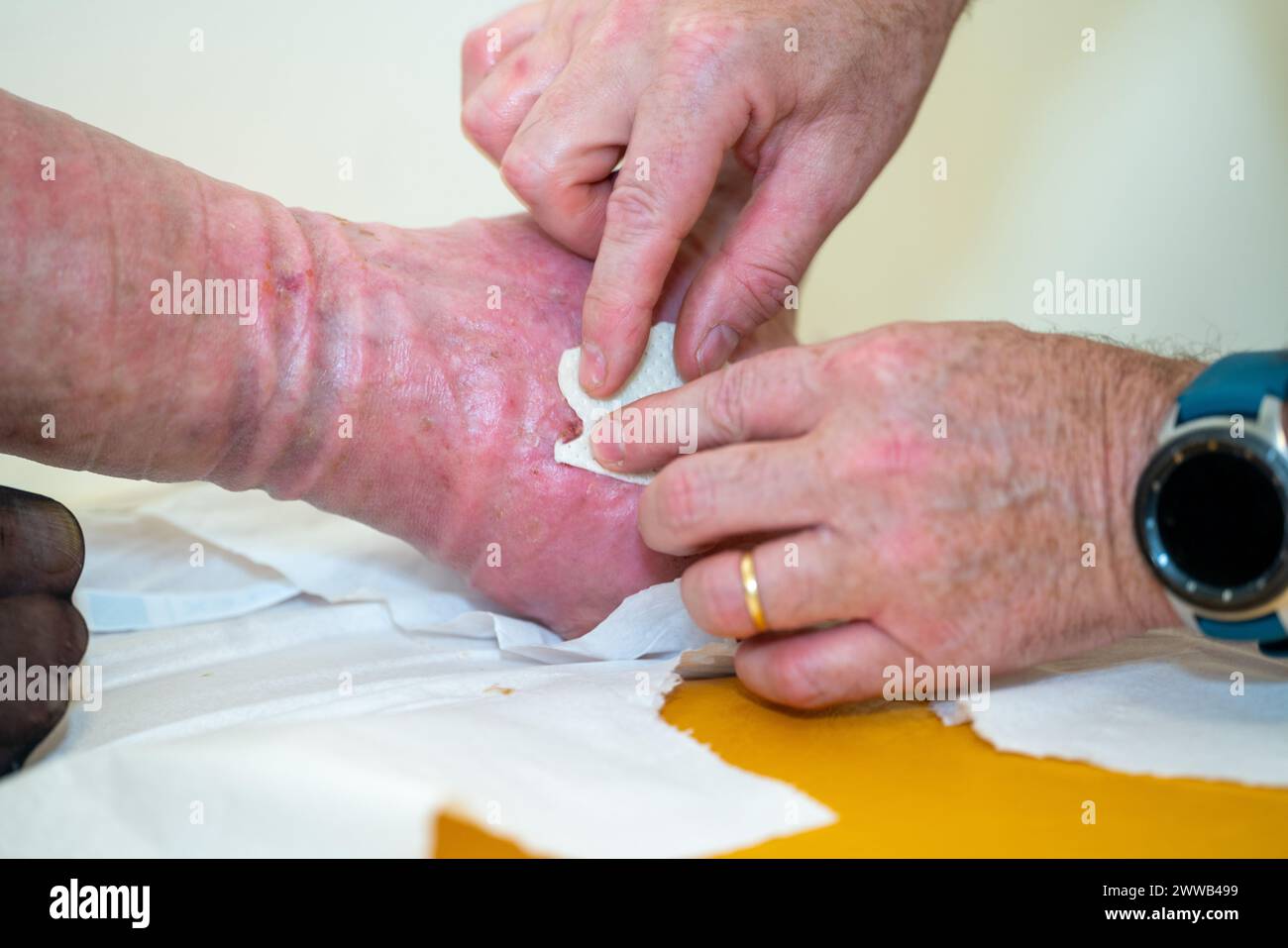 Care of a patient's foot ulcer. Wound cleaning and dressings Stock ...