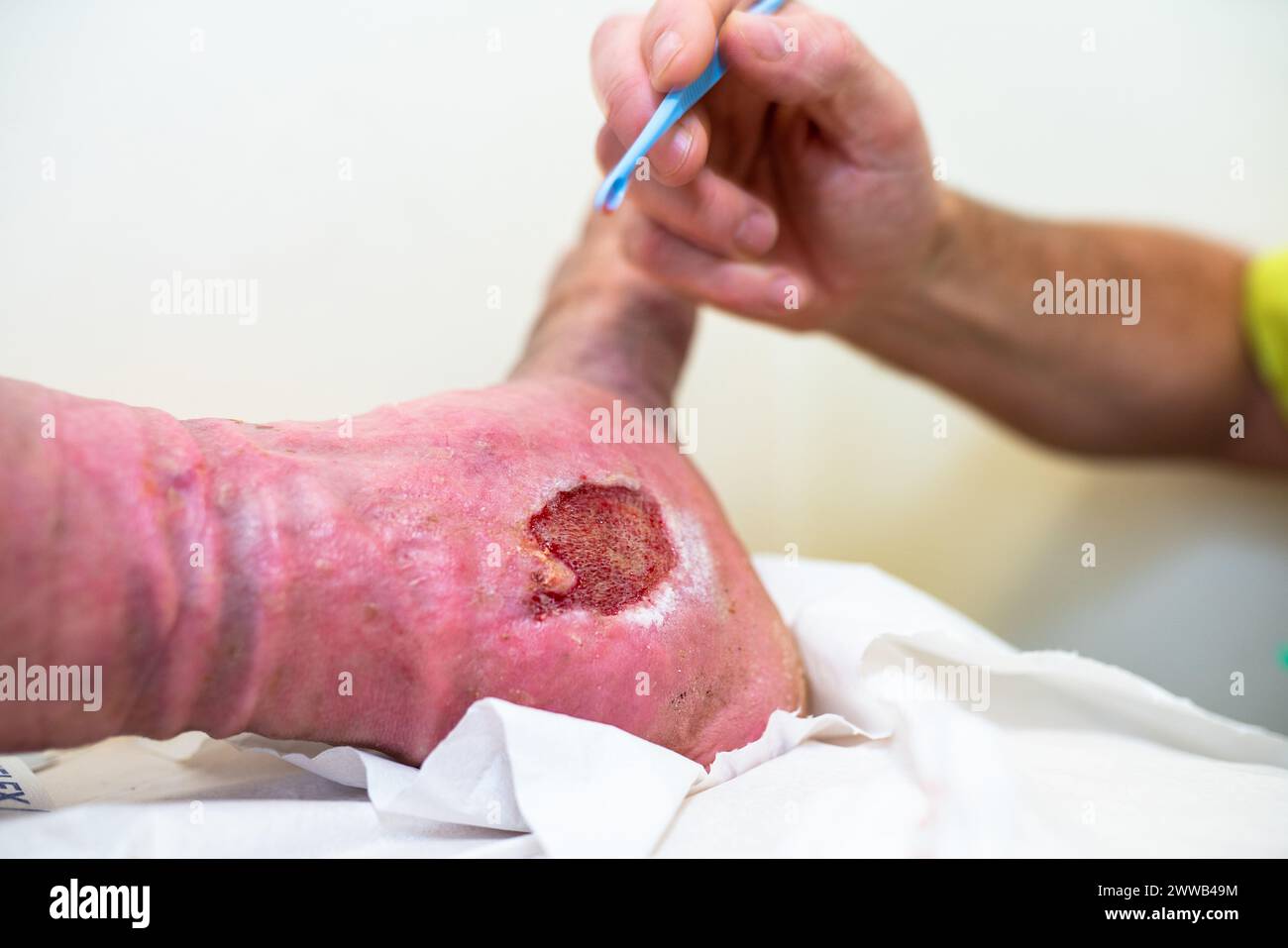 Care of a patient's foot ulcer. Wound cleaning and dressings Stock ...