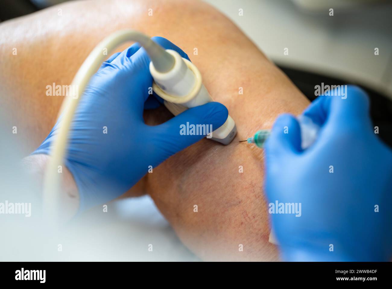 Treatment of varicose veins by foam echosclerotherapy, injection into a ...