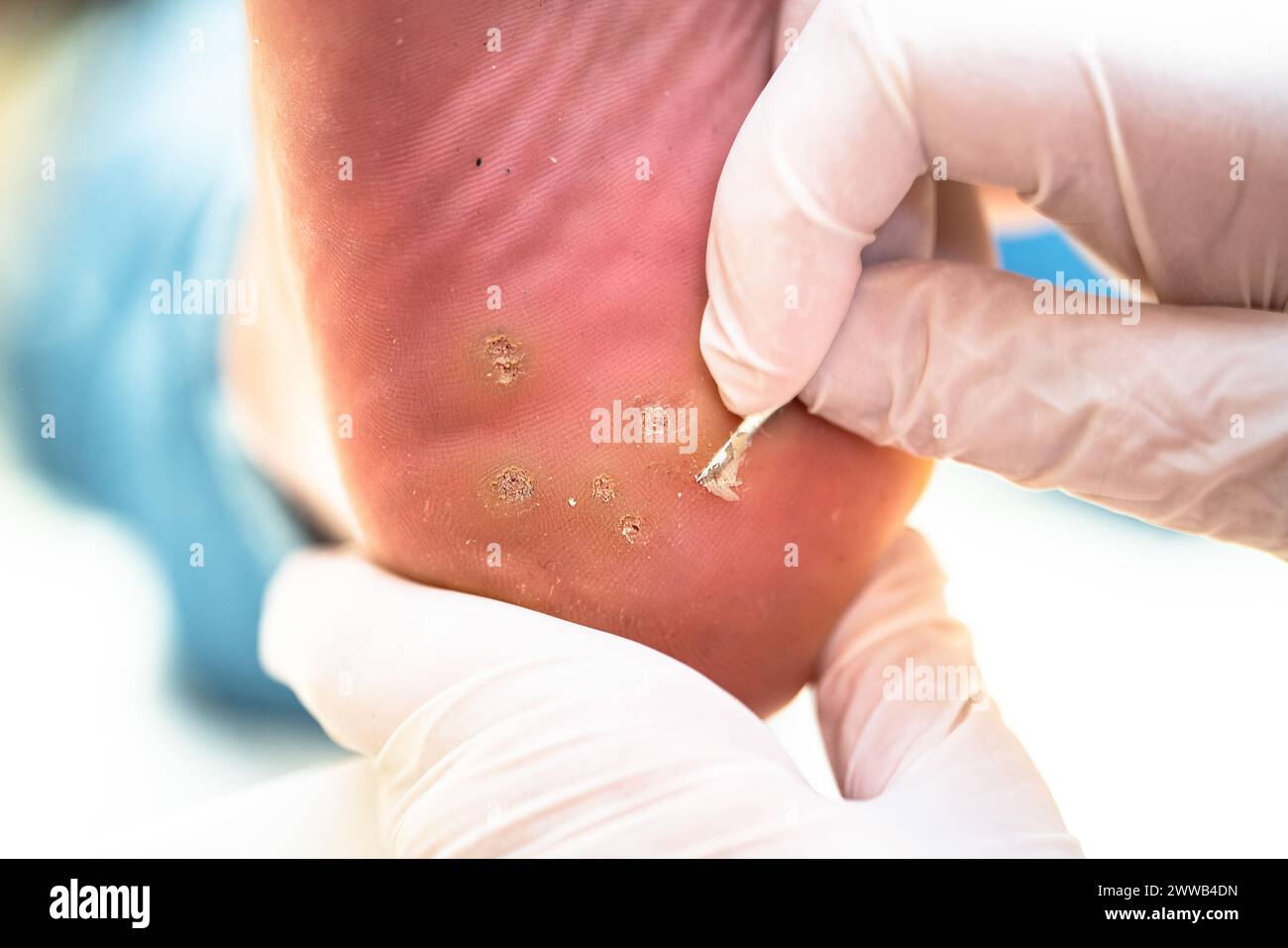 Liquid nitrogen treatment for mosaic plantar warts Stock Photo - Alamy
