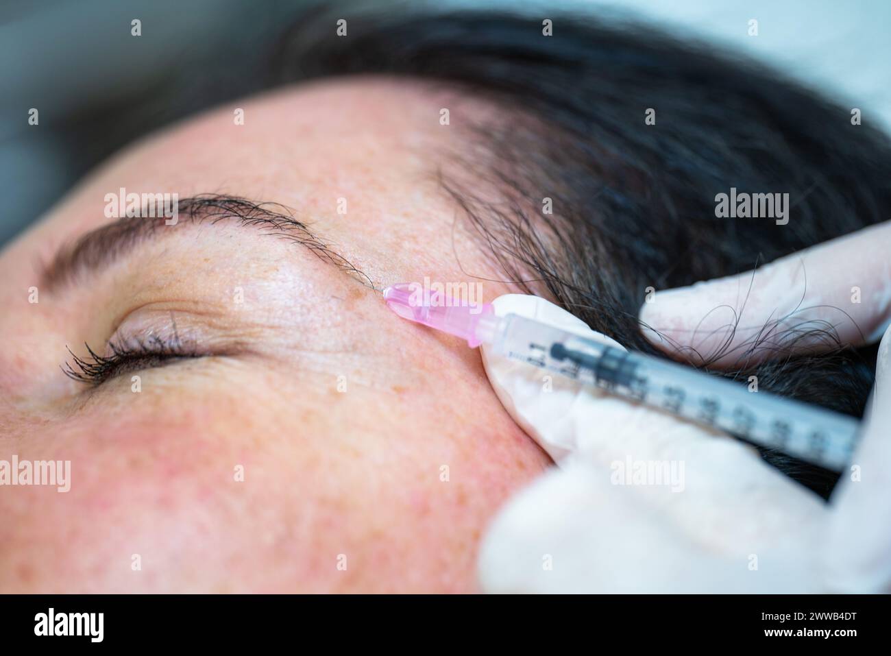 Crow's feet botox injections Stock Photo - Alamy
