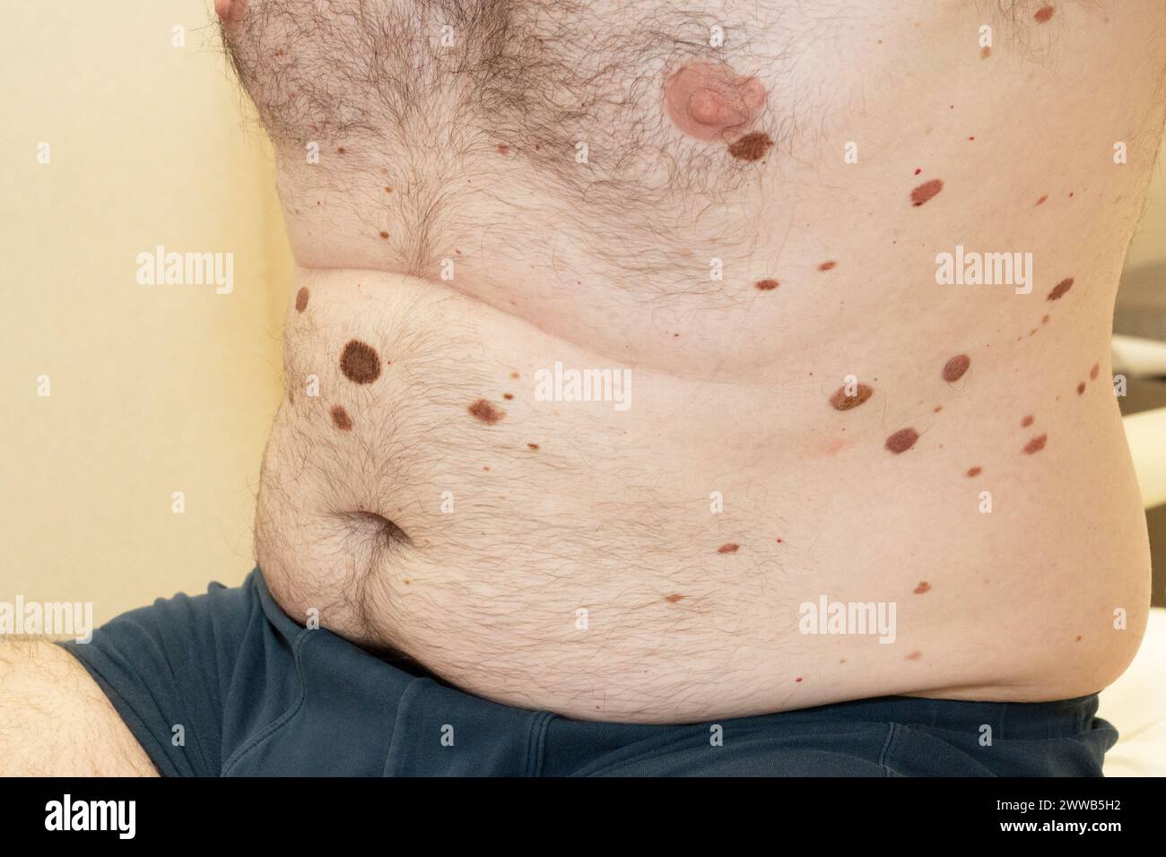 Checking moles on a patient. For the dermatologist, the problem is to ...