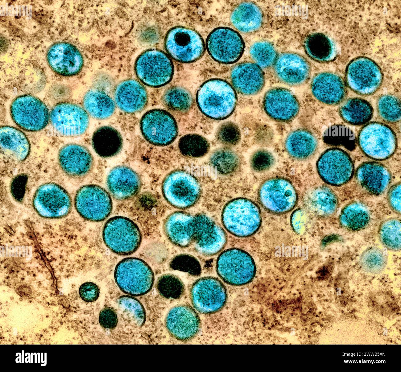 Colorized transmission electron micrograph of monkeypox particles (teal ...