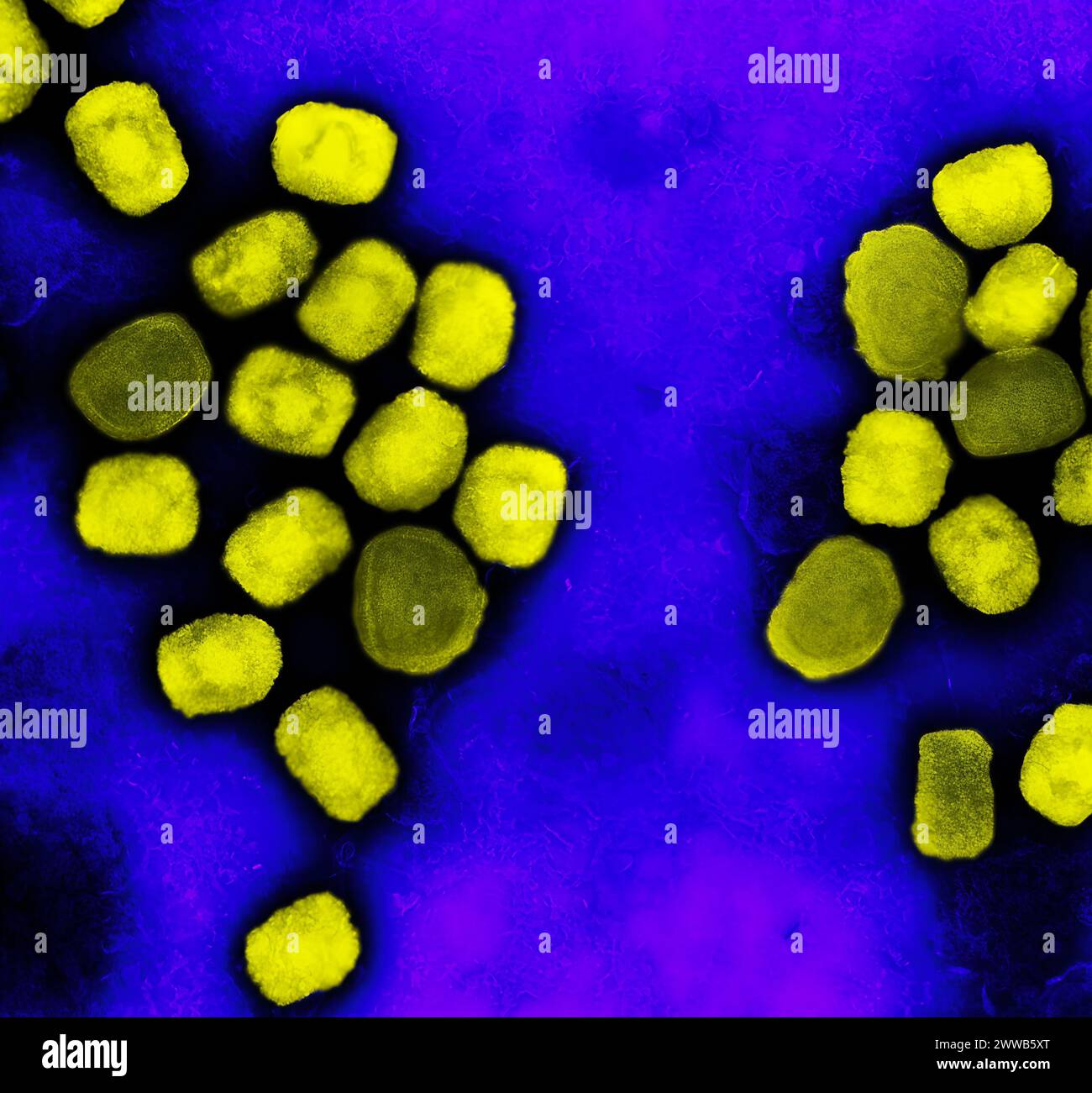 Colorized transmission electron micrograph of monkeypox virus particles ...