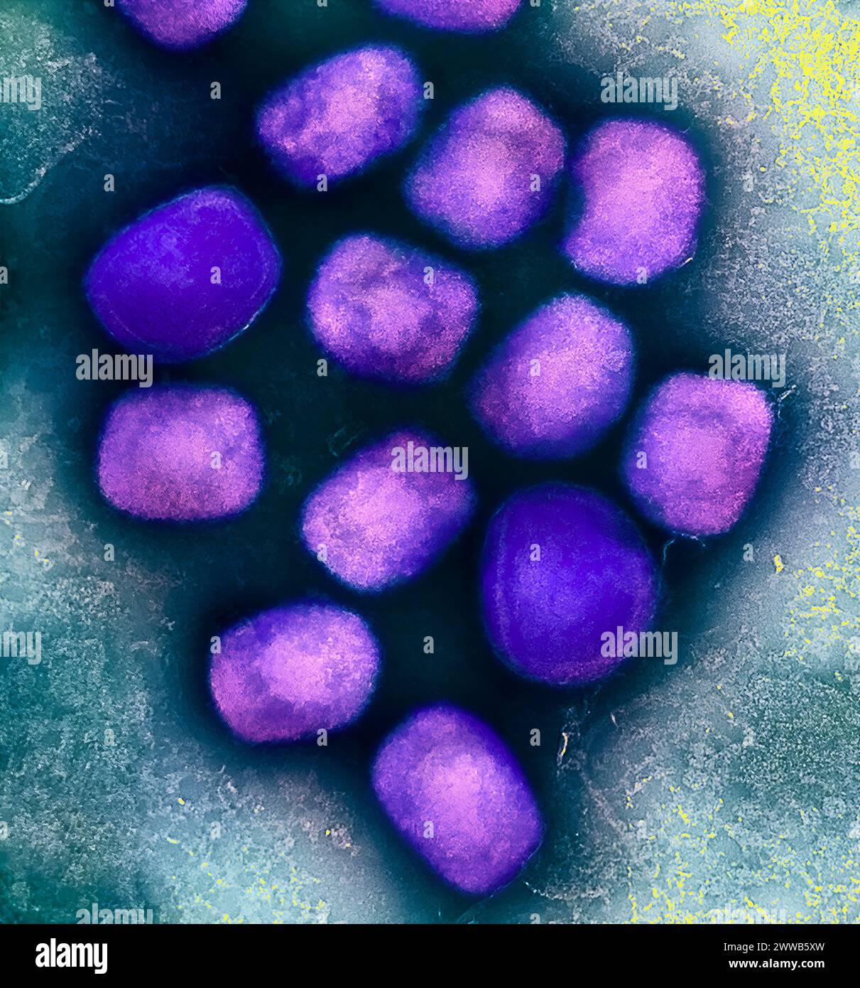 Colorized transmission electron micrograph of monkeypox virus particles ...