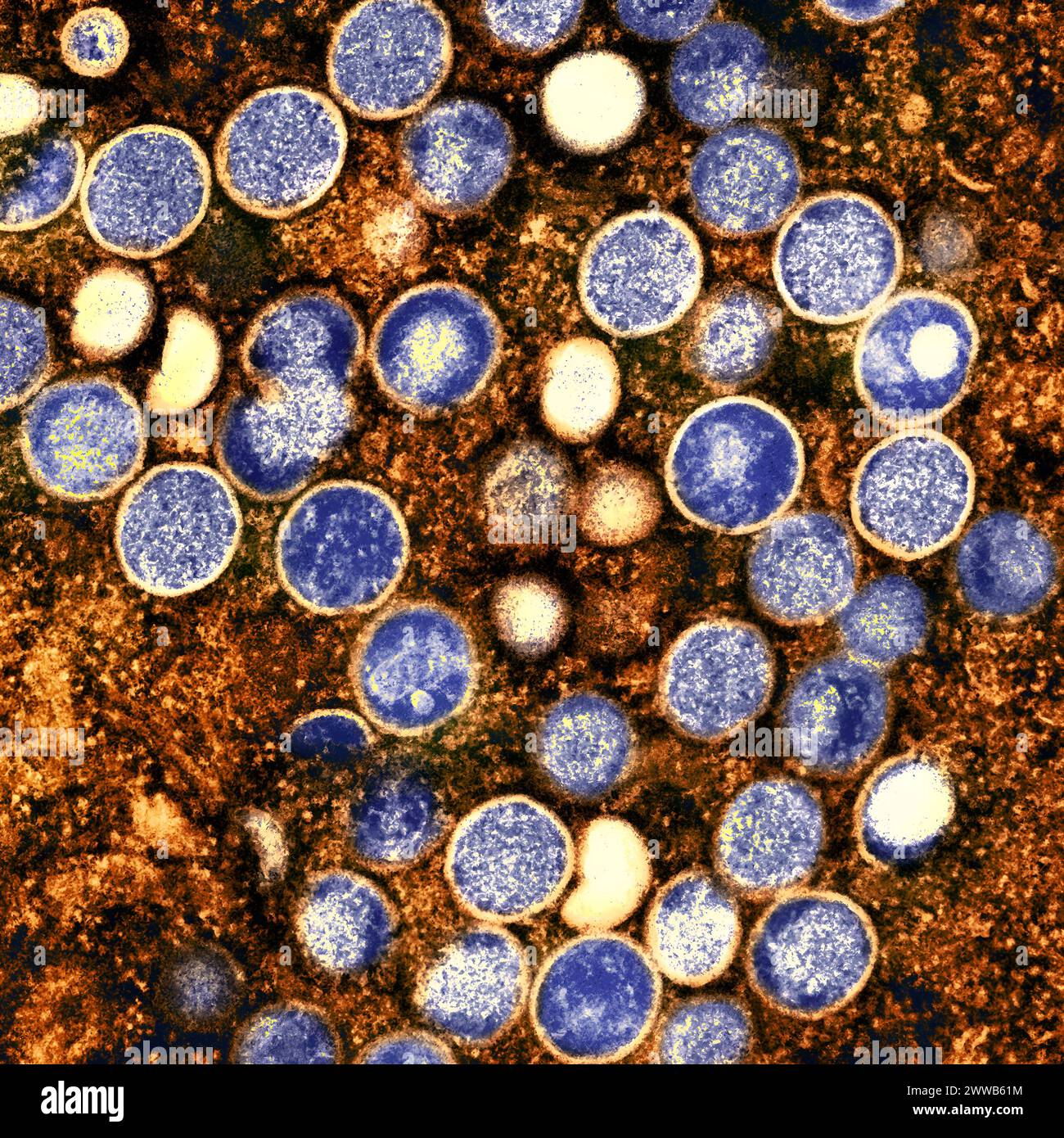 Colorized transmission electron micrograph of monkeypox particles ...