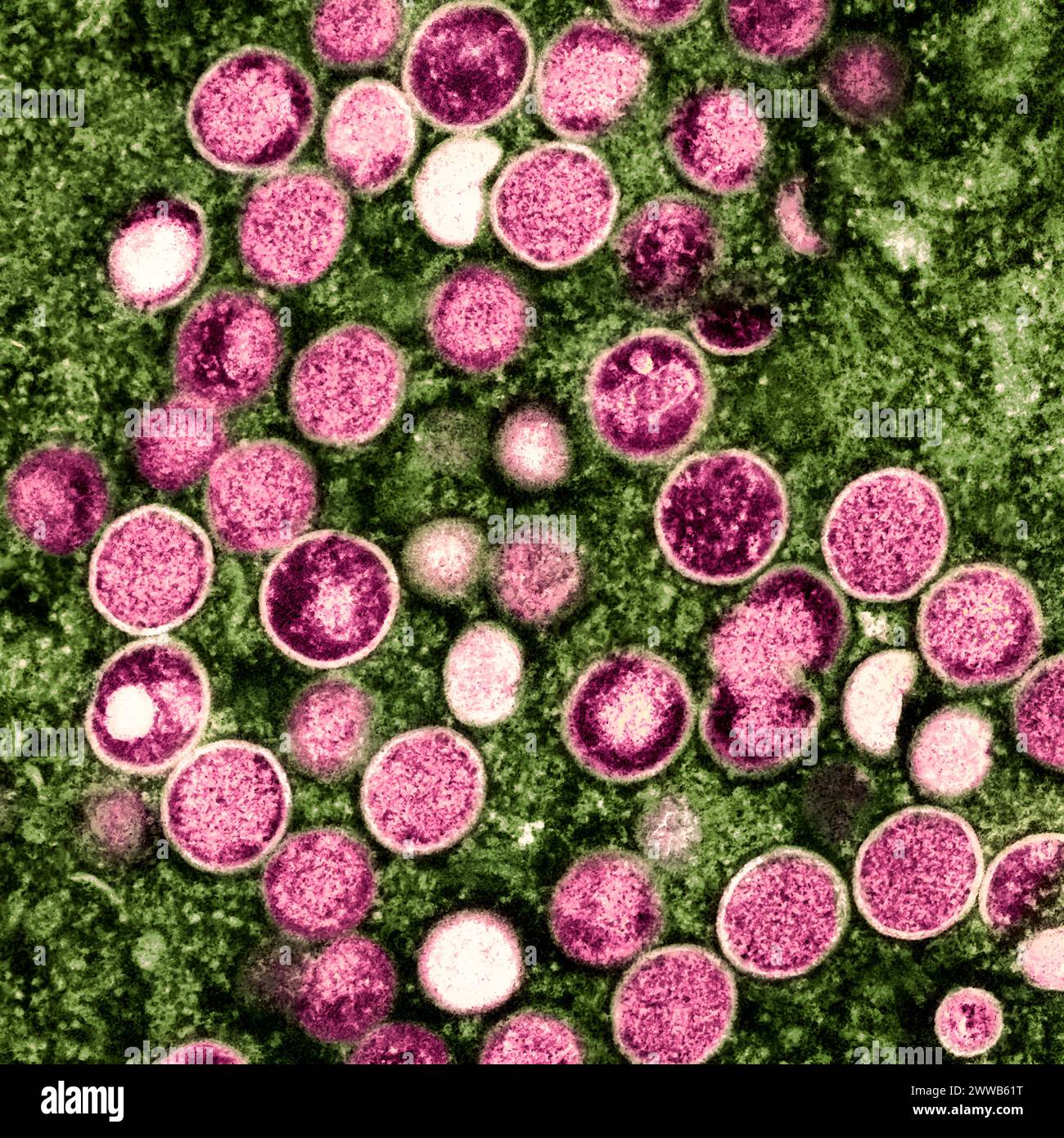 Colorized transmission electron micrograph of monkeypox particles (pink ...