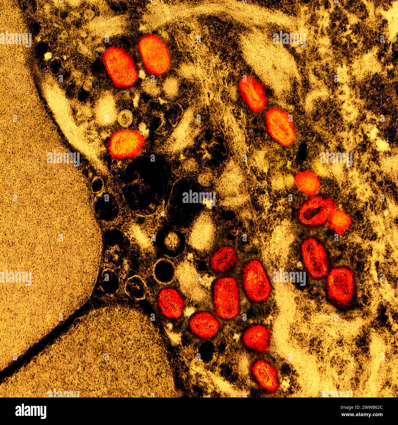 Colorized transmission electron micrograph of monkeypox particles ...
