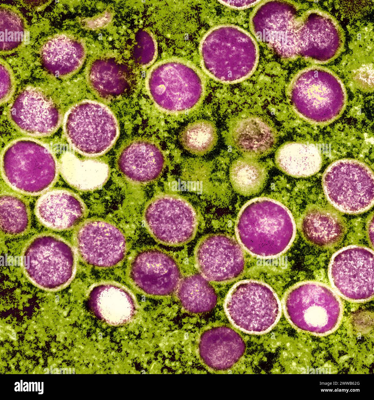 Colorized transmission electron micrograph of monkeypox particles (pink ...