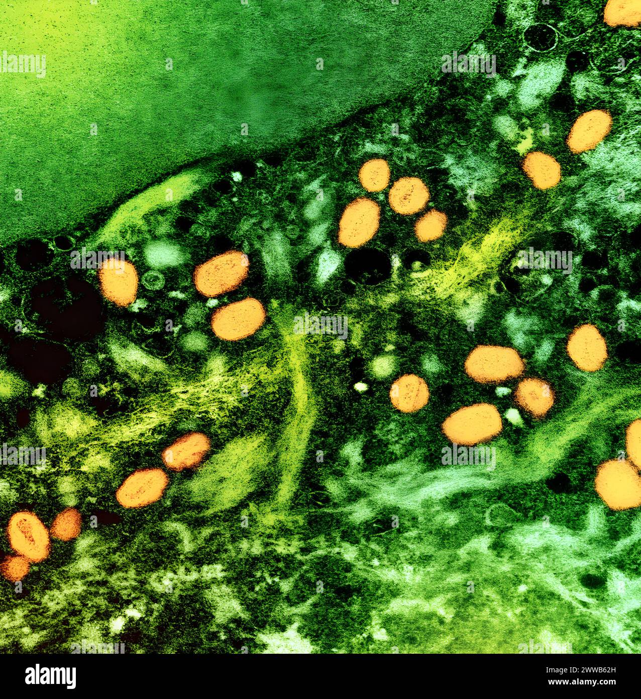 Colorized transmission electron micrograph of monkeypox particles ...