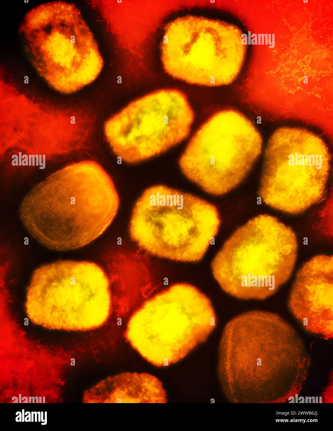 Colorized transmission electron micrograph of monkeypox virus particles ...