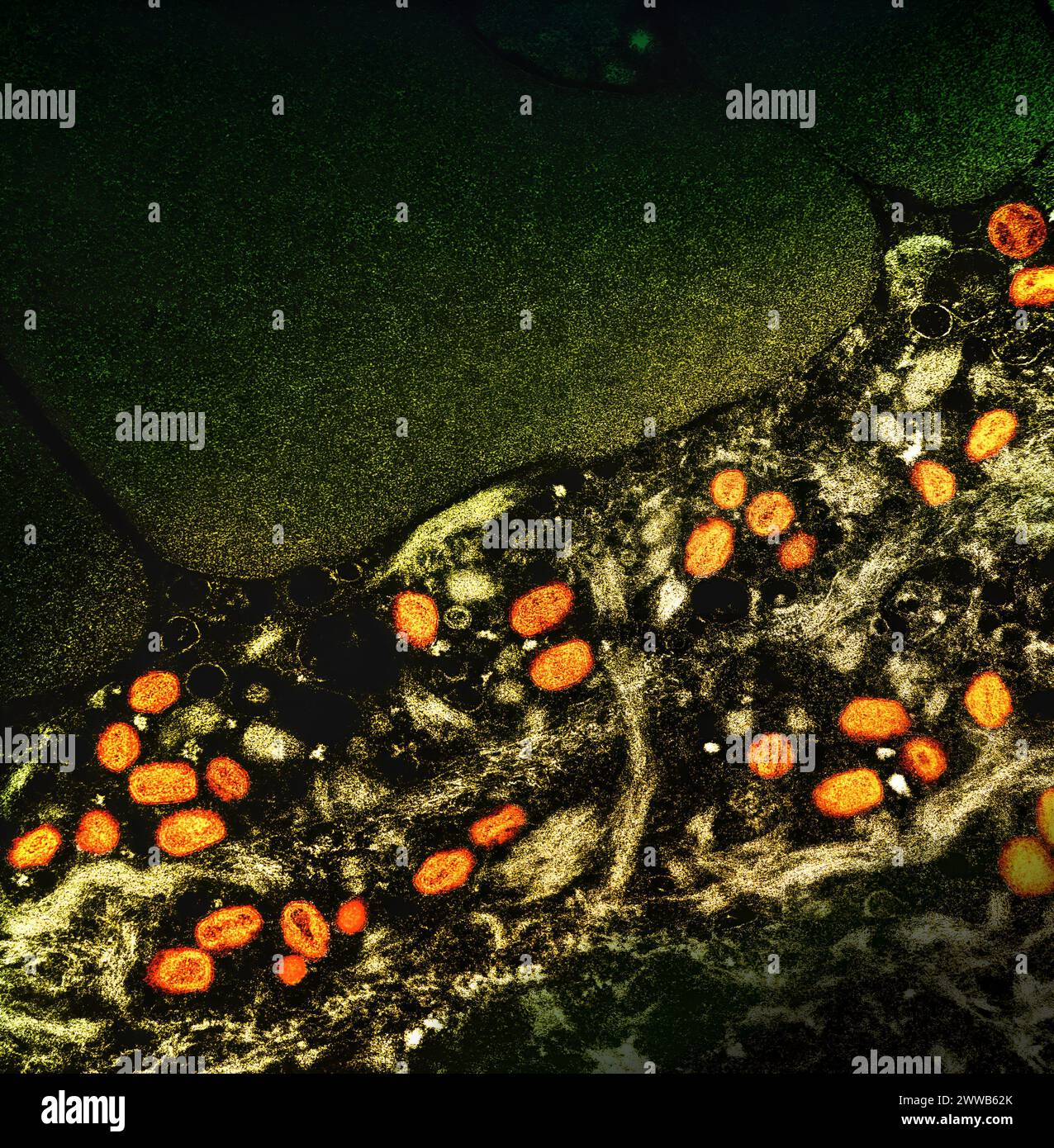 Colorized transmission electron micrograph of monkeypox particles ...