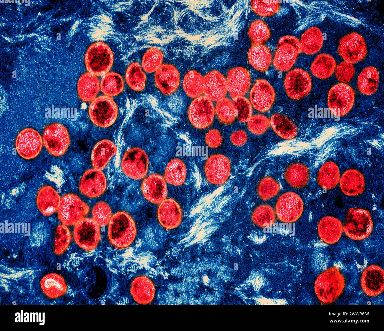Colorized transmission electron micrograph of monkeypox virus particles ...