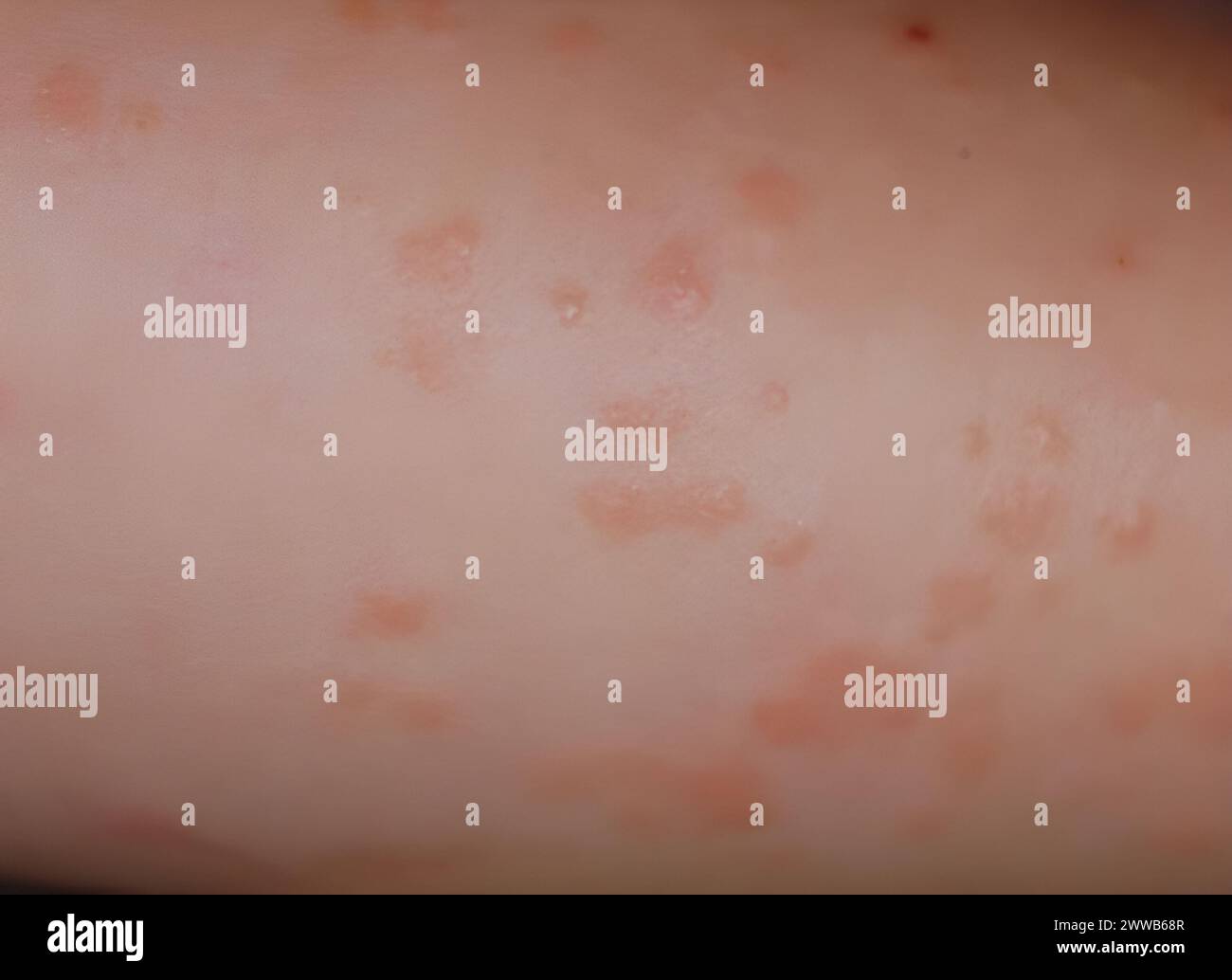 Gianotti Crosti syndrome, also called infantile papular acrodermatitis ...