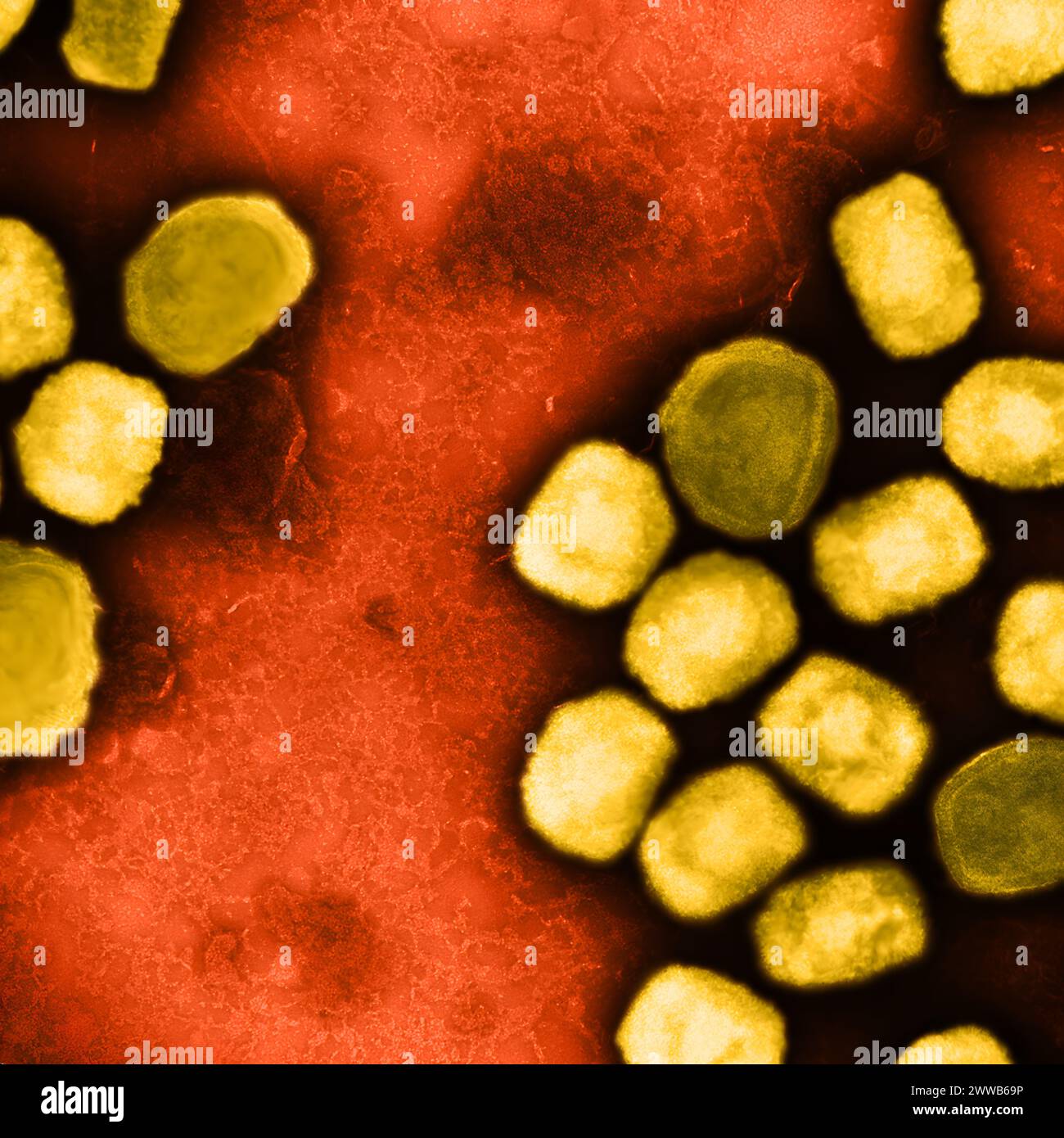 Colorized transmission electron micrograph of monkeypox virus particles ...