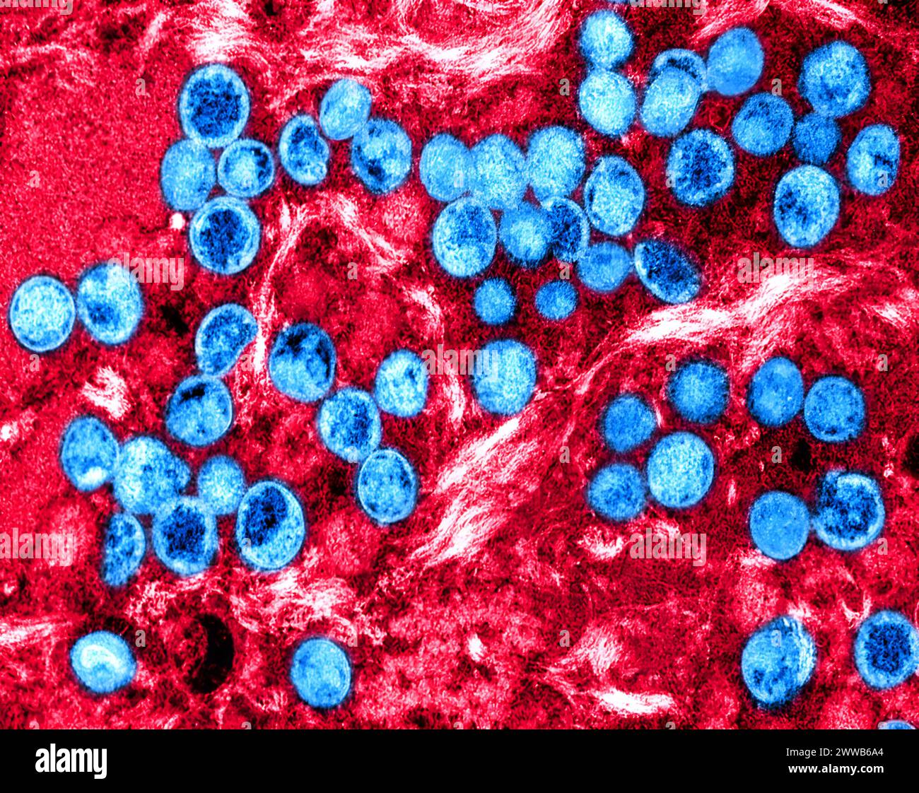 Colorized transmission electron micrograph of monkeypox virus particles ...
