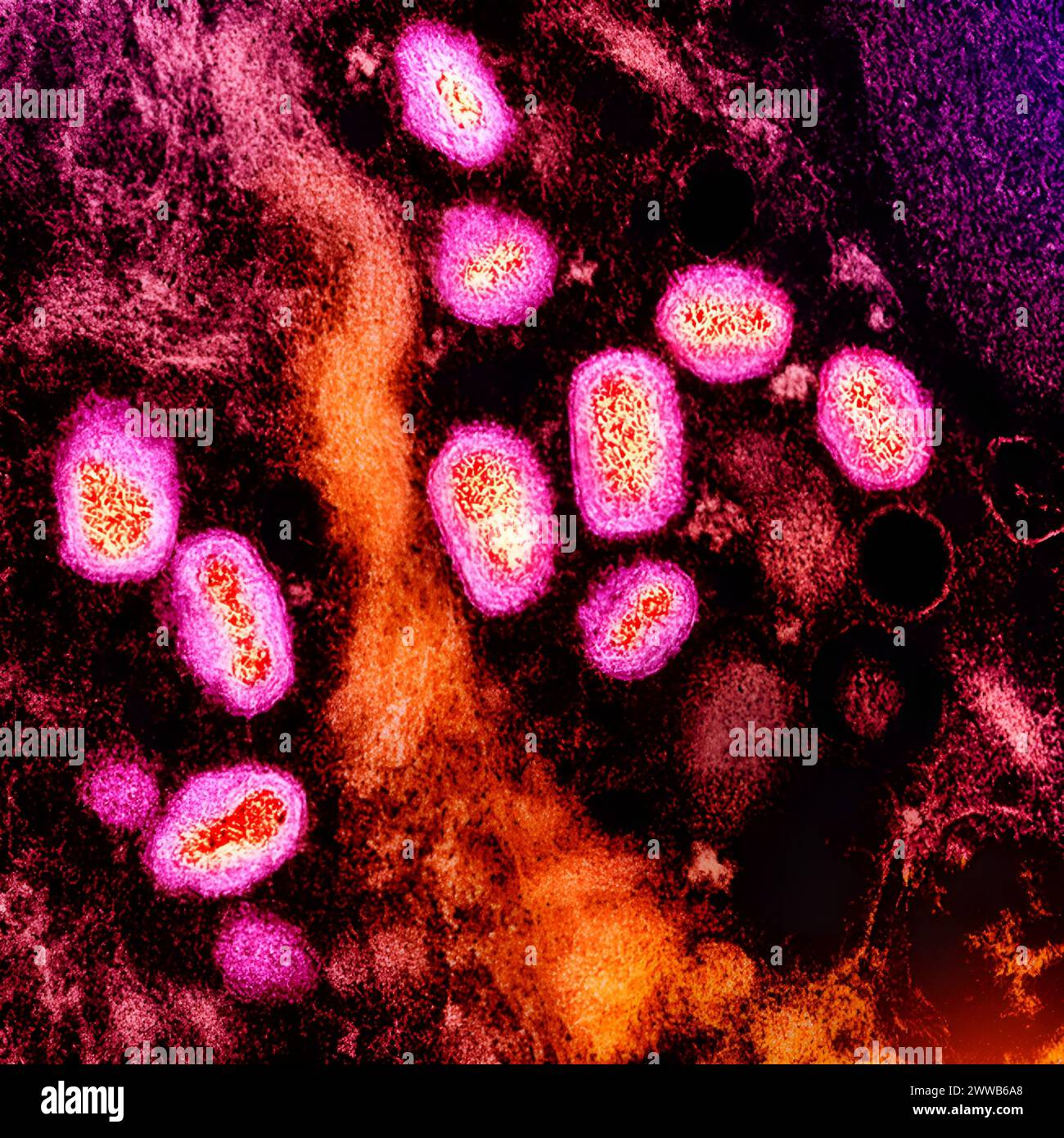 Colorized transmission electron micrograph of monkeypox virus particles ...