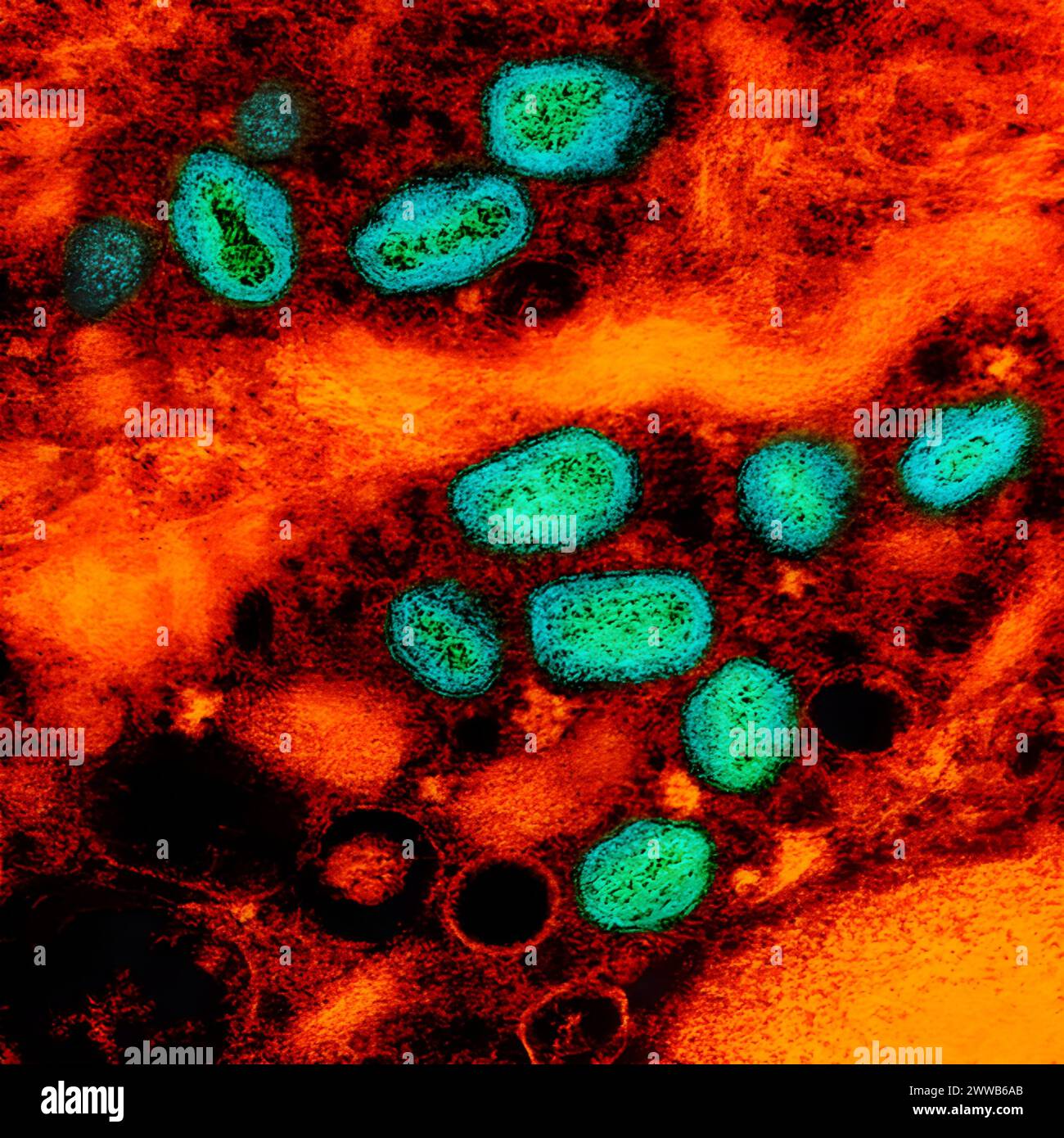 Colorized transmission electron micrograph of monkeypox virus particles ...