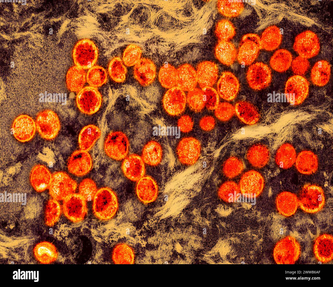 Colorized transmission electron micrograph of monkeypox virus particles ...