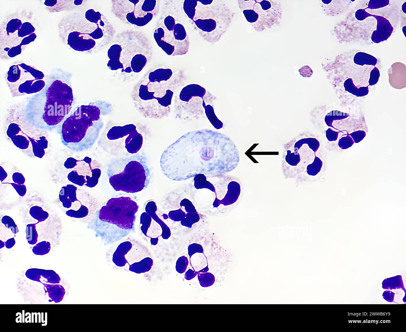 A fixed cerebrospinal fluid cytospin showing a Giemsa-Wright stained ...