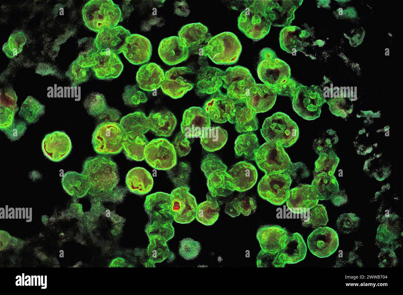Naegleriasis (or amoebic meningoencephalitis or AMP) is a fatal ...