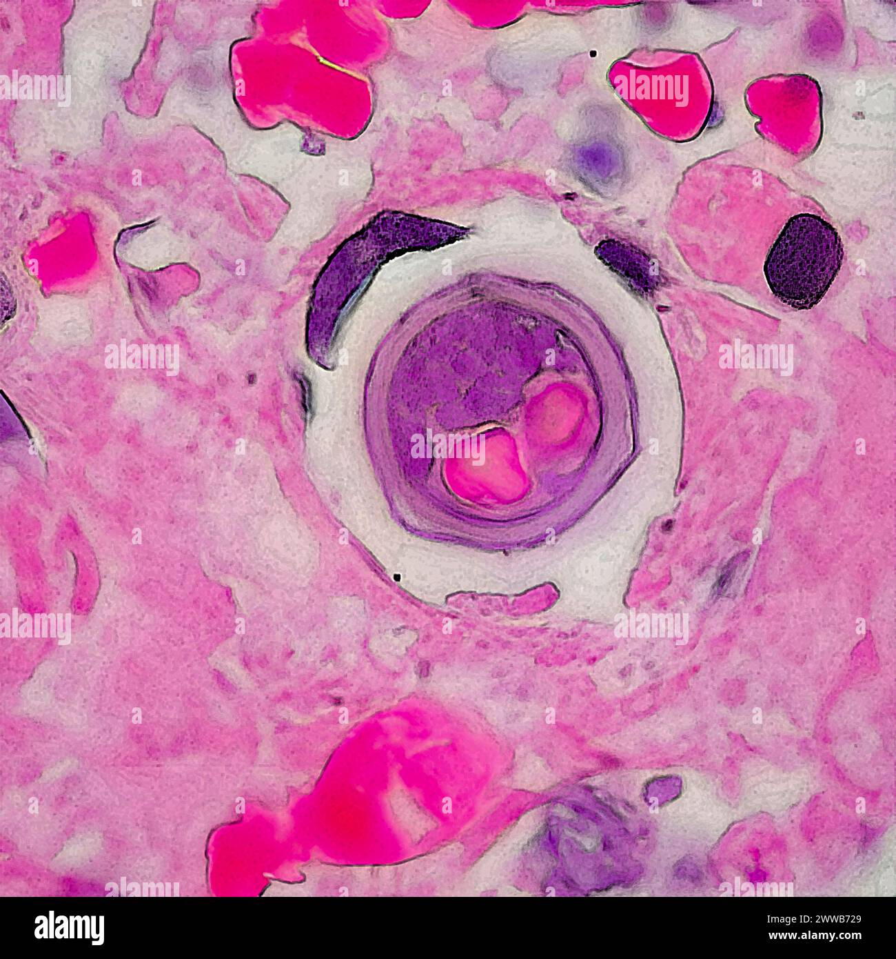 Acanthamoeba is a microscopic, free-living amoeba, or amoeba (single ...