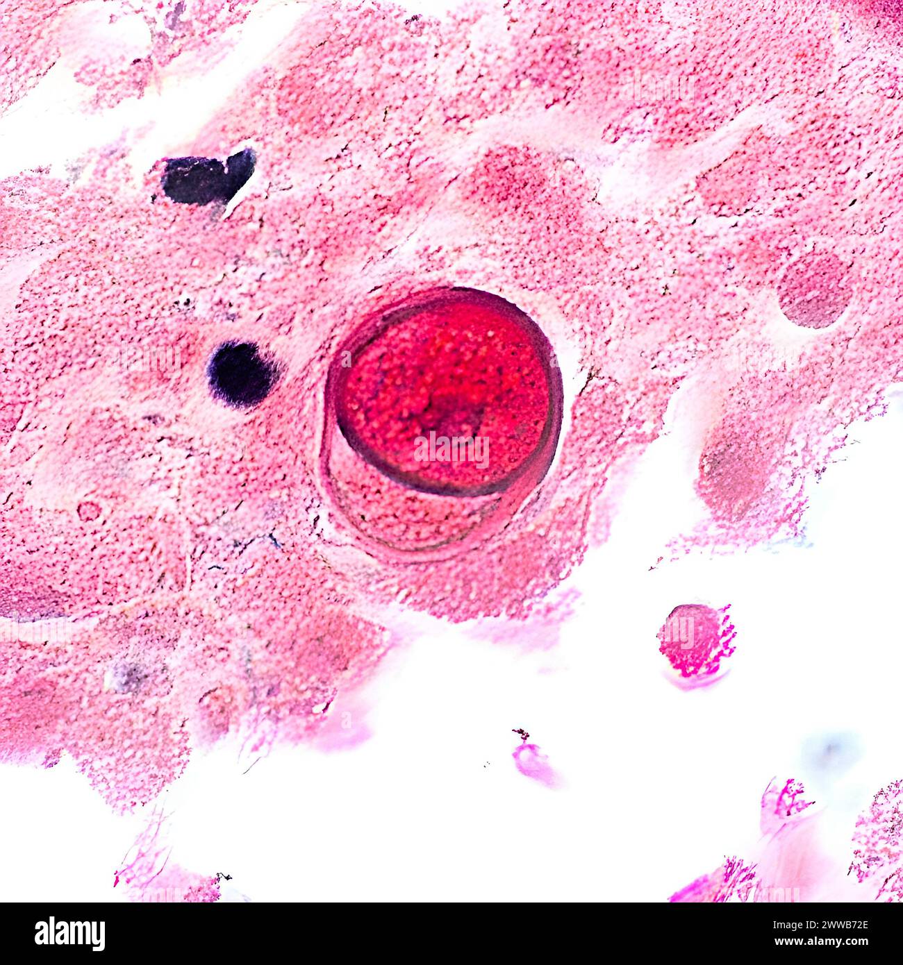Acanthamoeba is a microscopic, free-living amoeba, or amoeba (single ...