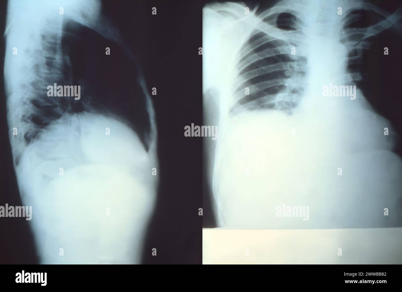 This image depicts two thoracoabdominal x-rays, which reveal the ...