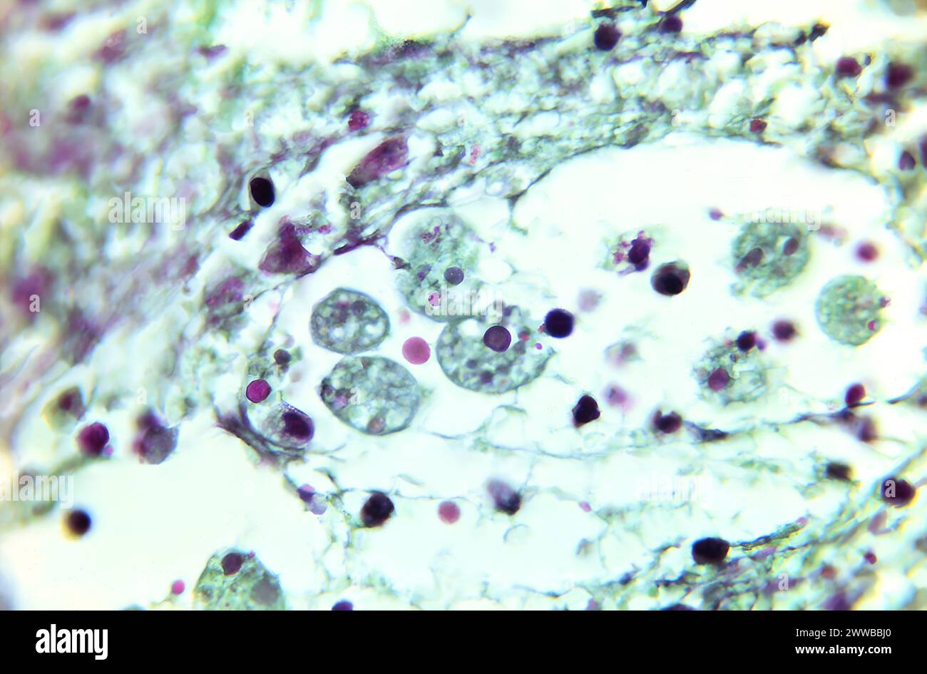 Under 675X magnification, this photomicrograph revealed the presence of Entamoeba histolytica ...